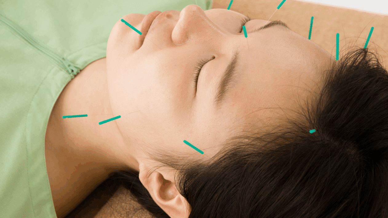 Facial Acupuncture: A Holistic Approach to Healthy Aging